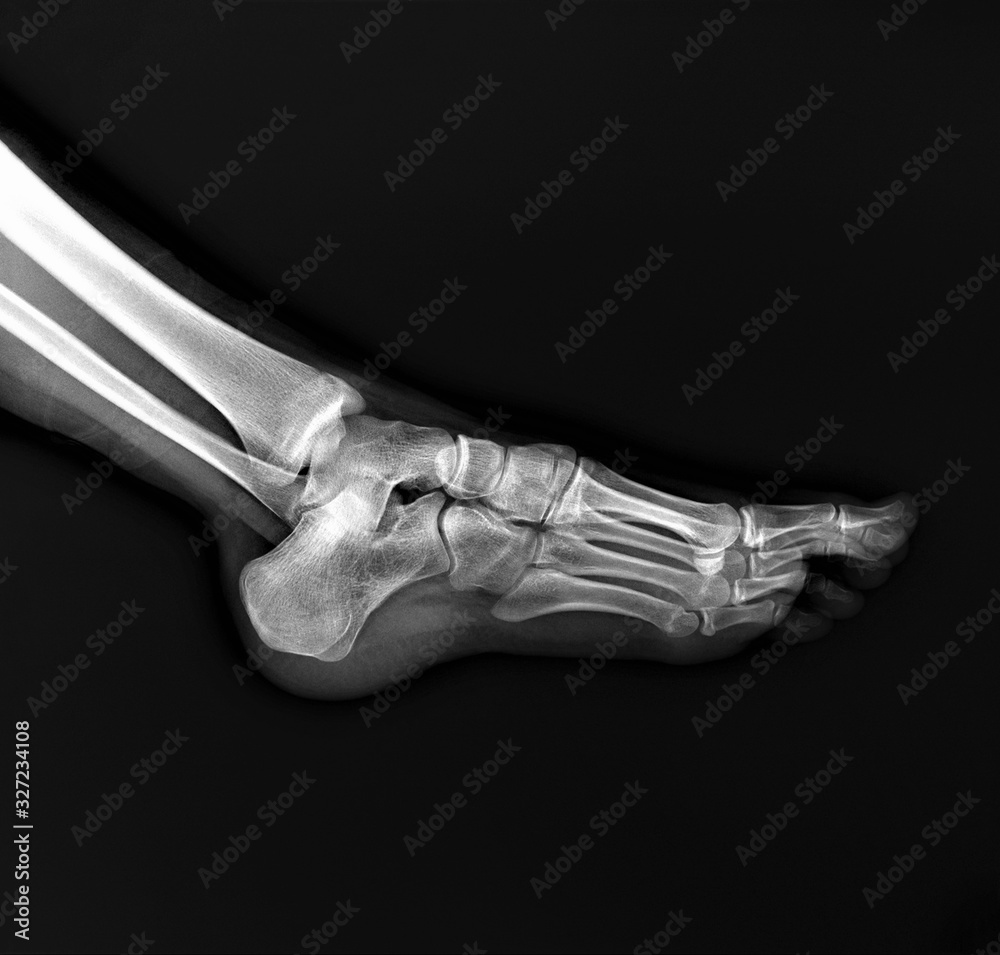 x-ray of the foot, diagnosis of fractures, arthritis, deforming ...