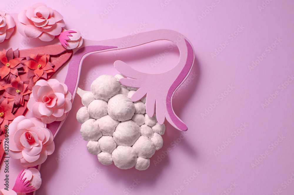 Concept polycystic ovary syndrome, PCOS. Women reproductive system ...