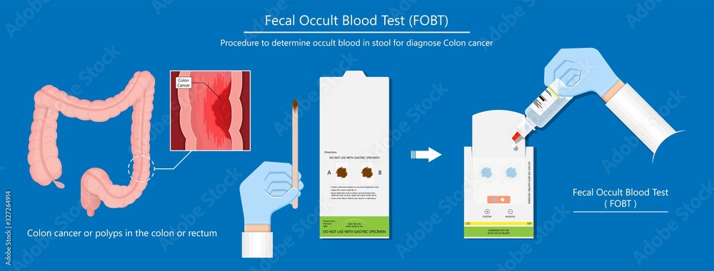 Fecal occult blood test FOBT lab stool sample bleeding screen risk ...
