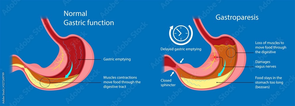 Gastroparesis stomach gastric emptying digestion disease infection ...