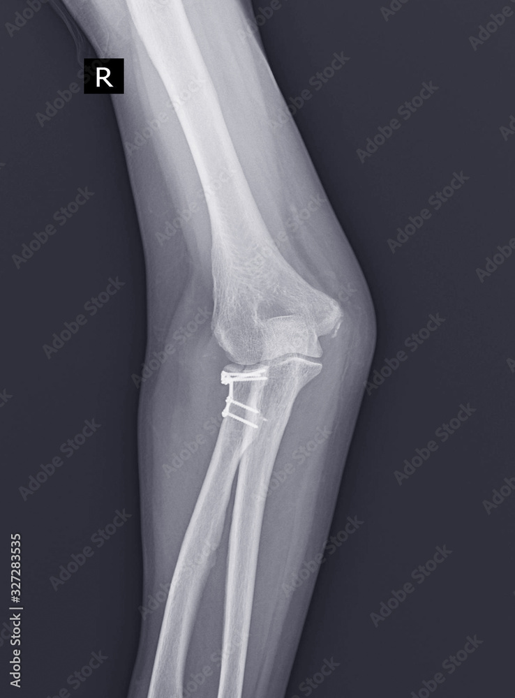 X-ray Elbow joint.After open reduction and internal fixation for radial ...