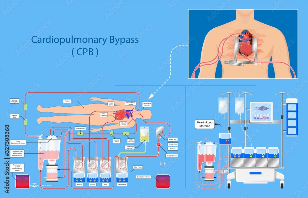 Cardiopulmonary bypass heart lung machine coronary oxygenator ...
