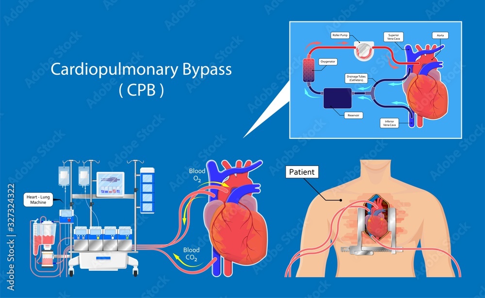 Cardiopulmonary bypass heart lung machine coronary oxygenator ...