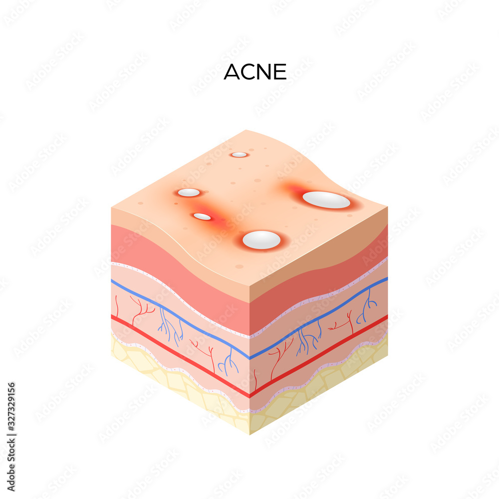 Acne vulgaris or pimple cross-section of human skin layers structure ...