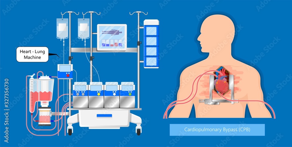 Cardiopulmonary bypass heart lung machine coronary oxygenator ...
