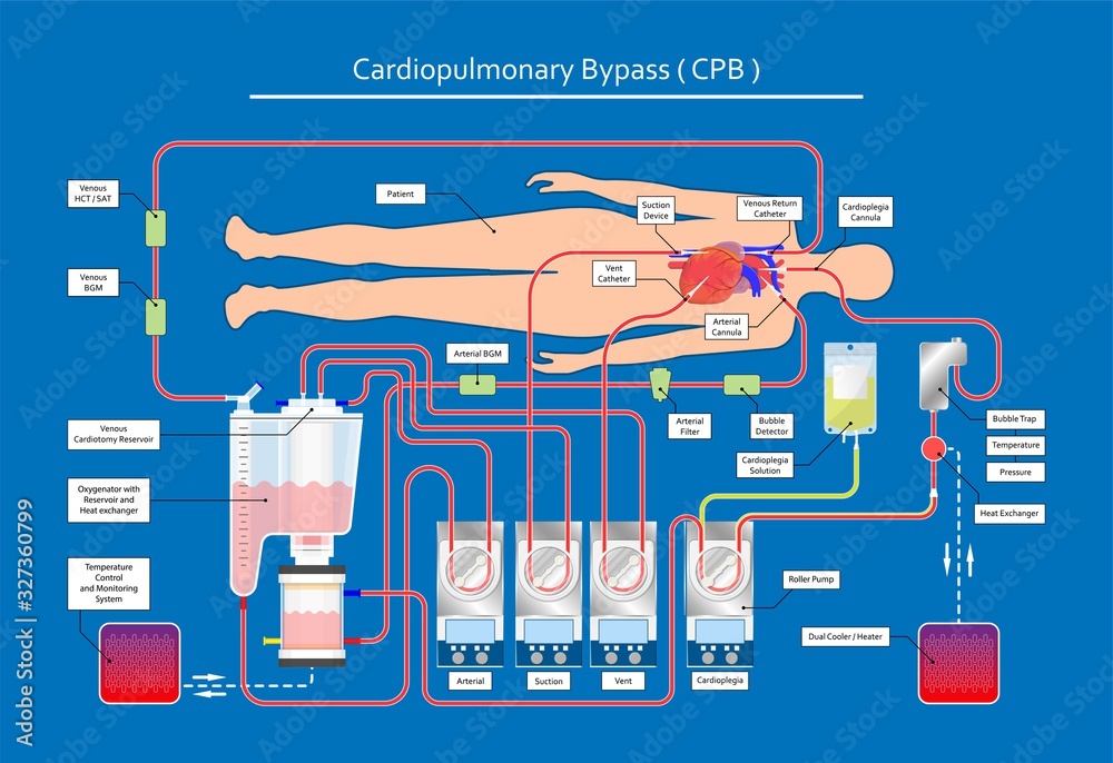 Cardiopulmonary bypass heart lung machine coronary oxygenator ...
