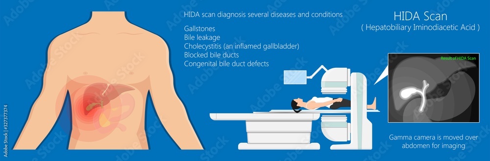 HIDA scan diagnosis treat liver scintigraphy inject cells scanner ...