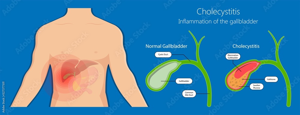 HIDA scan diagnosis treat liver scintigraphy inject cells scanner ...