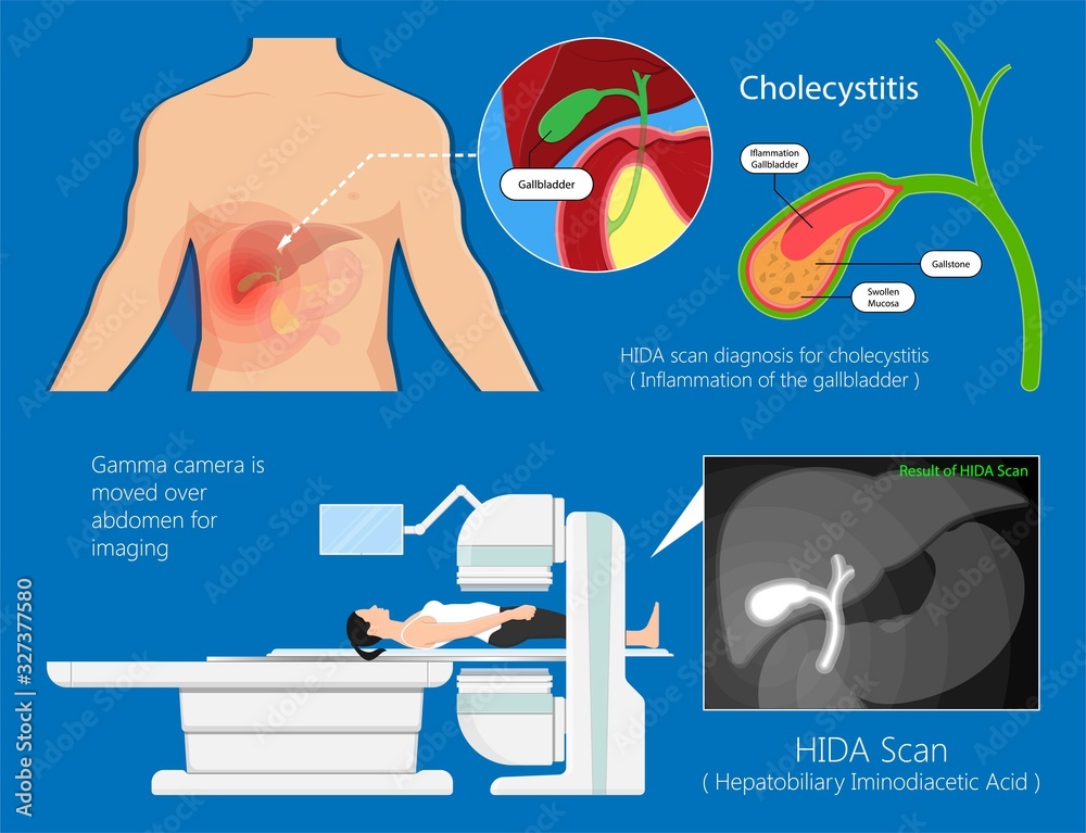 Vecteur Stock HIDA scan diagnosis treat liver scintigraphy inject cells ...