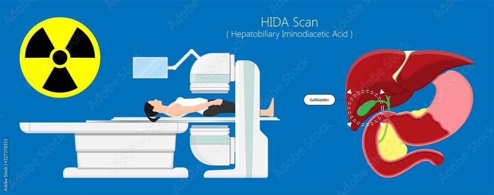 Vecteur Stock HIDA scan diagnosis treat liver scintigraphy inject cells ...