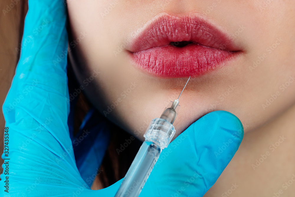 Lips injection. Injections of the lips. Correction form the upper lip ...