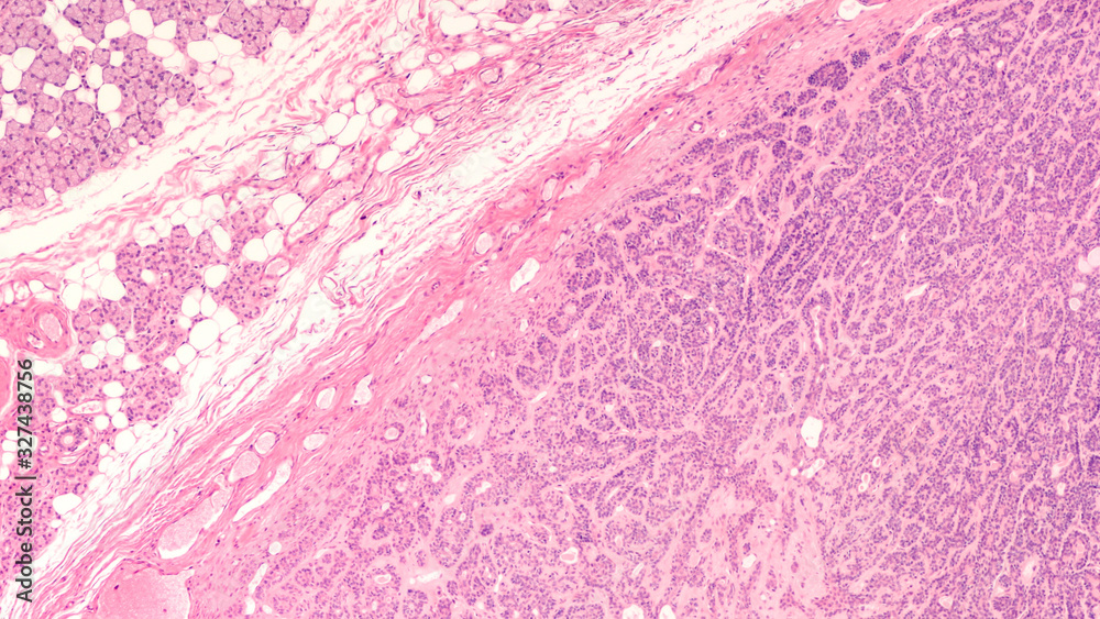 Photomicrograph of a basal cell (monomorphic) adenoma, of salivary ...