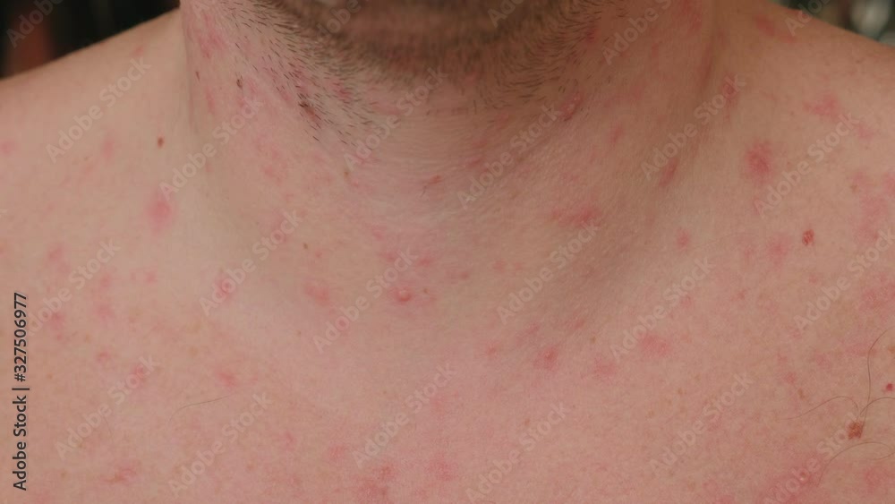 Close-up of skin with red rashes from chickenpox. The neck and chest of ...