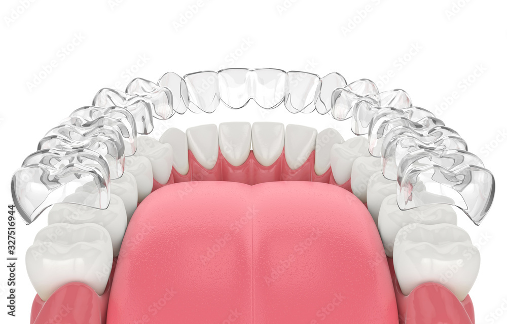 3d render of invisalign removable retainer with lower jaw ilustração do ...