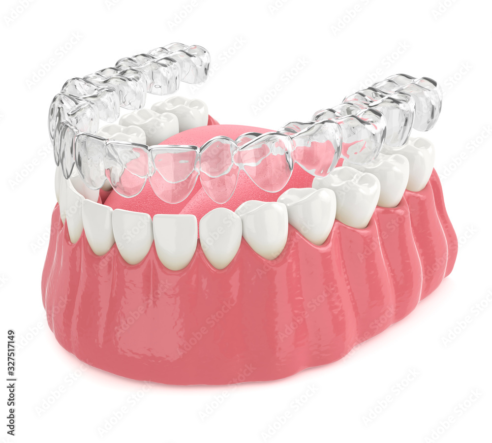 3d render of invisalign removable retainer with lower jaw ilustração do ...