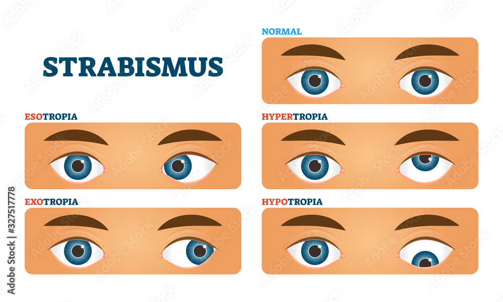 Strabismus or cross eyed vision condition, vector illustrations Vektor ...