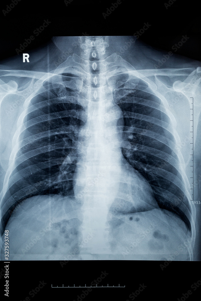 A CT scan of a normal lung Stock Photo | Adobe Stock