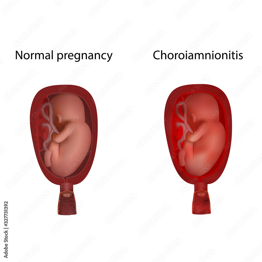 Normal and choroiamnionitis. Fetus in uterus, womb, placenta, umbilical ...