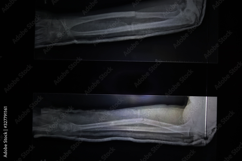Broken hand bone x ray after plaster cast Stock Photo | Adobe Stock