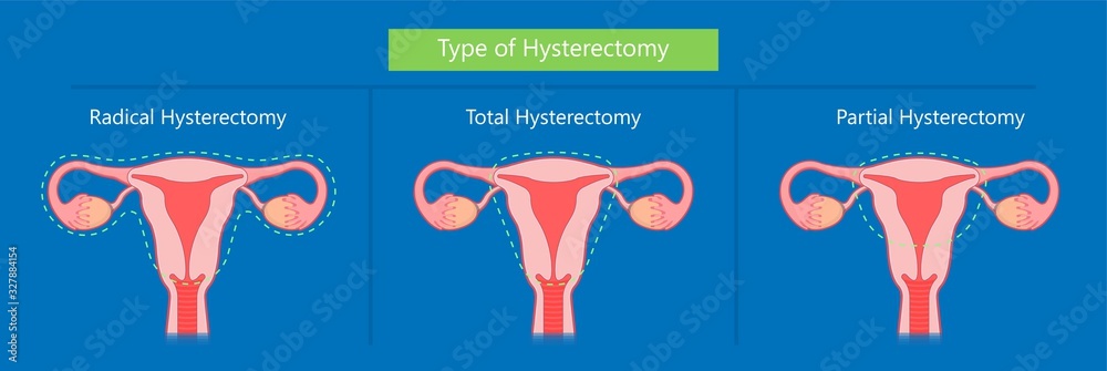 laparoscopic hysterectomy medical surgical treat cervix ovary subtotal ...