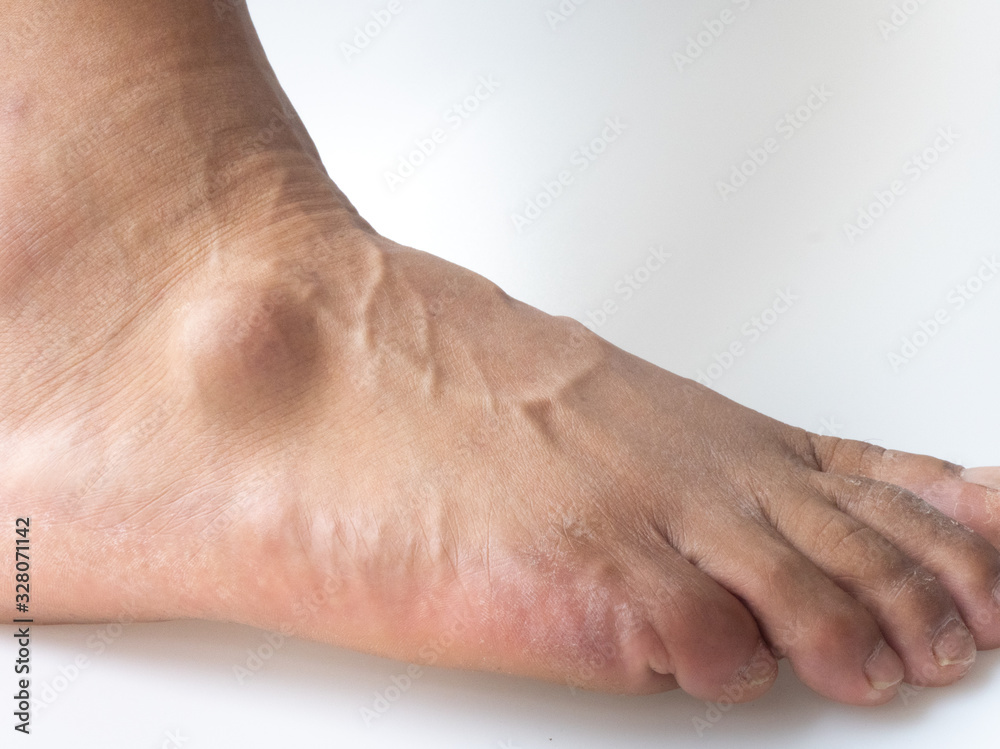 Big ganglion cysts,a sac of jellylike fluid,is on the right foot of man ...