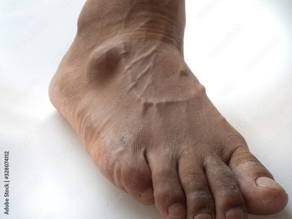 Big ganglion cysts,a sac of jellylike fluid,is on the right foot of man ...