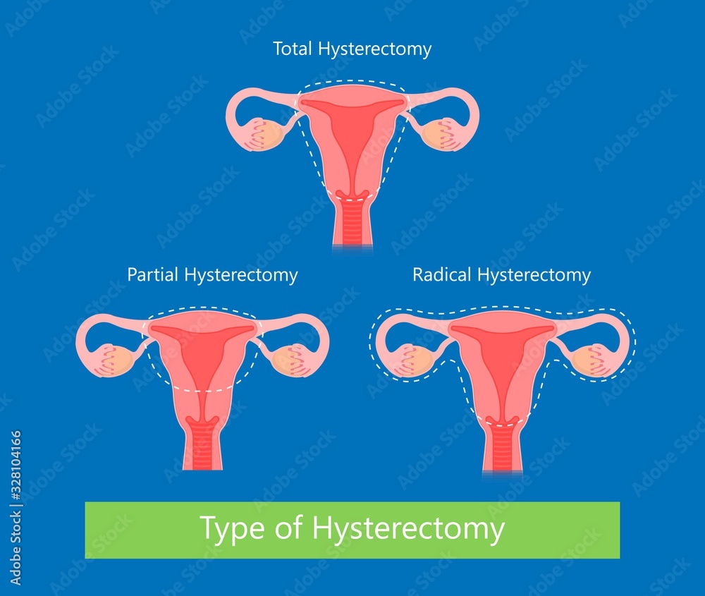 laparoscopic hysterectomy medical surgical treat cervix ovary subtotal ...