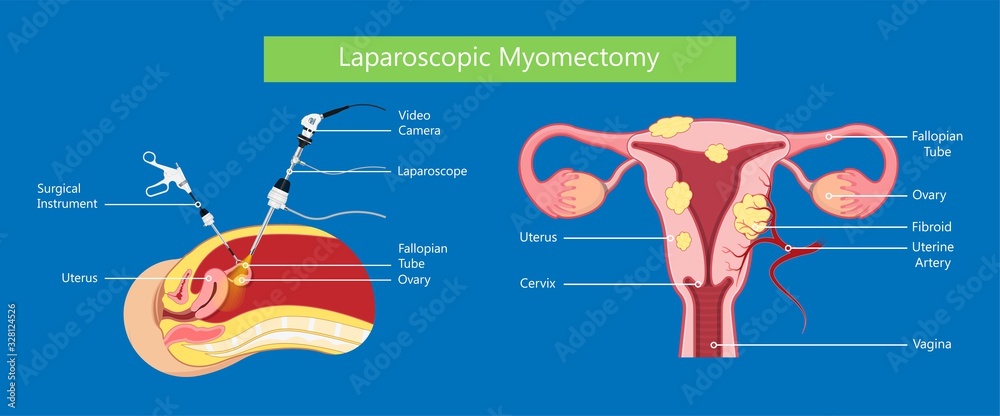 laparoscopic hysterectomy medical surgical treat cervix ovary subtotal ...