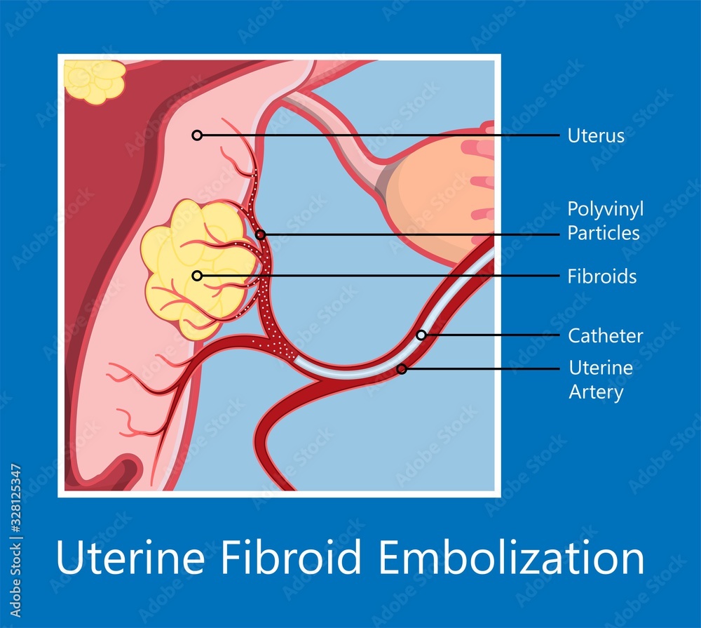 laparoscopic hysterectomy medical surgical treat cervix ovary subtotal ...