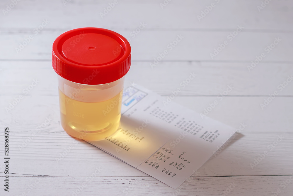 Urine sample in container with medical report Stock Photo | Adobe Stock