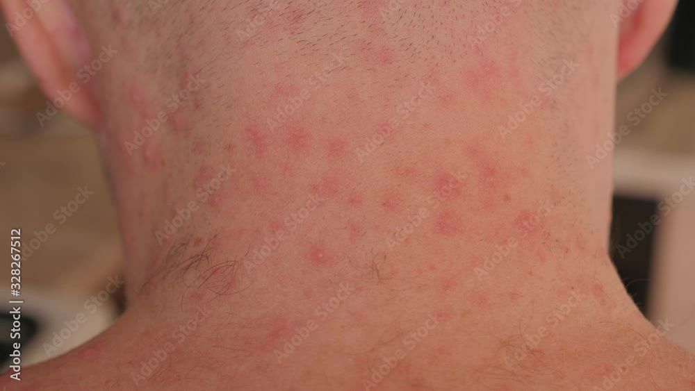 Close-up of the back and neck with rashes and blisters from chickenpox ...