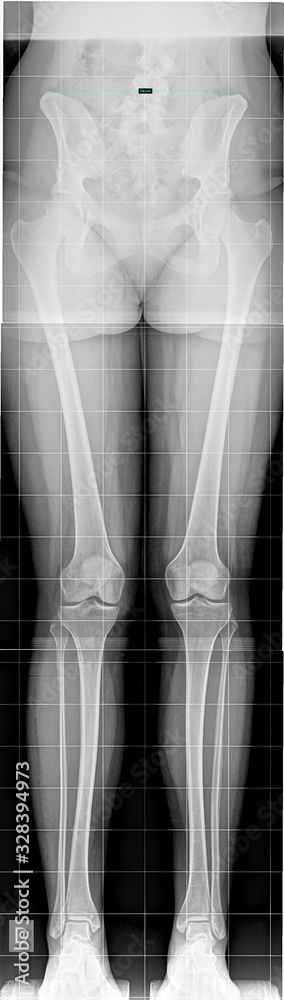 Real half body X ray scan, from hips to feet. A female radiograph ...