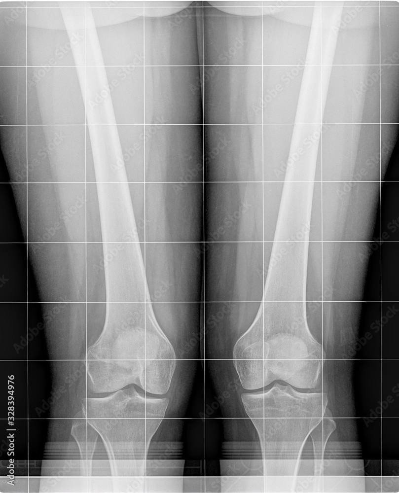 Two knees with a genu valgum x ray scan. Radiograph examination. Stock ...