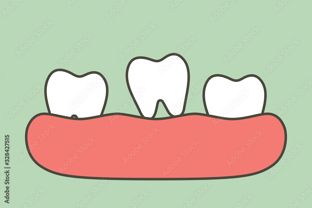 loose tooth, tooth is fall out of the gum - dental cartoon vector flat ...
