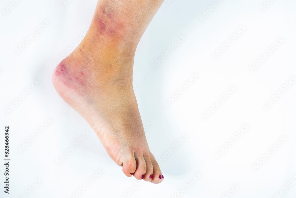 Woman's leg with sprained ankle isolated on white background. Twisted ...
