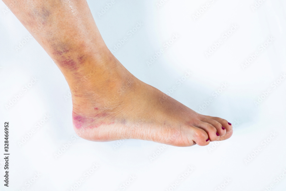 Woman's leg with sprained ankle isolated on white background. Twisted ...