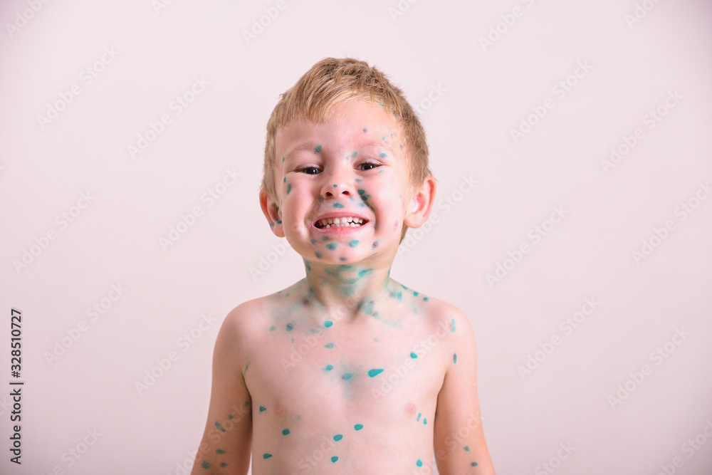 Young toddler,boy with chickenpox. Sick child with chickenpox. Varicella virus or Chickenpox ...