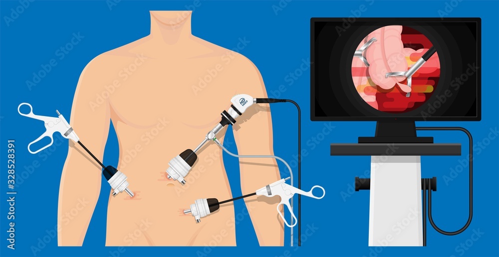 appendectomy medical surgery organ colon tool heal room body doctor ...