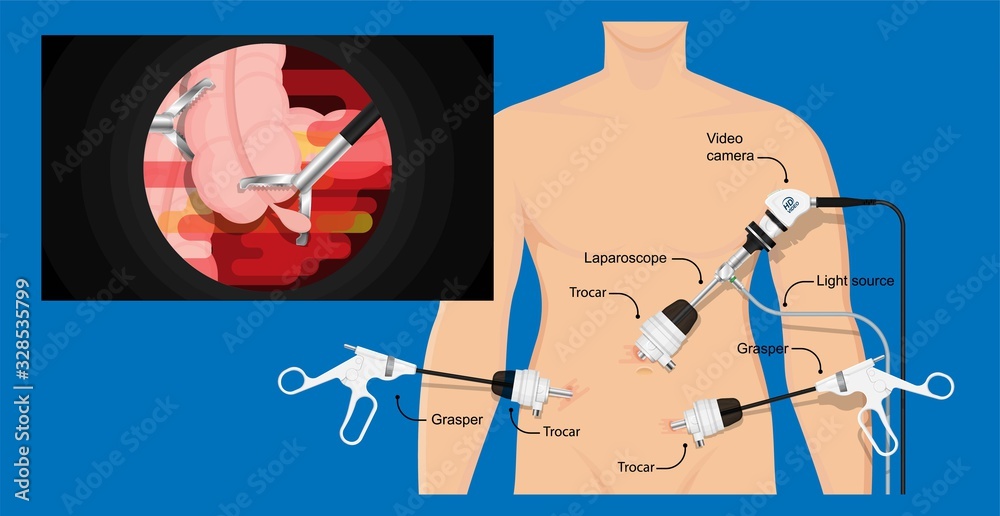 appendectomy medical surgery organ colon tool heal room body doctor pain scars liver cancer ...