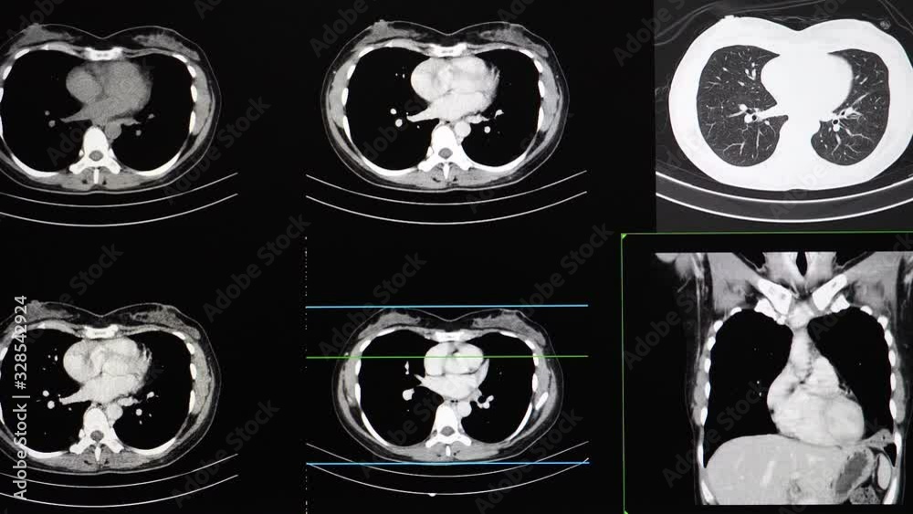 A mornitor showing a CT scan or computer tomography of a chest cavity ...