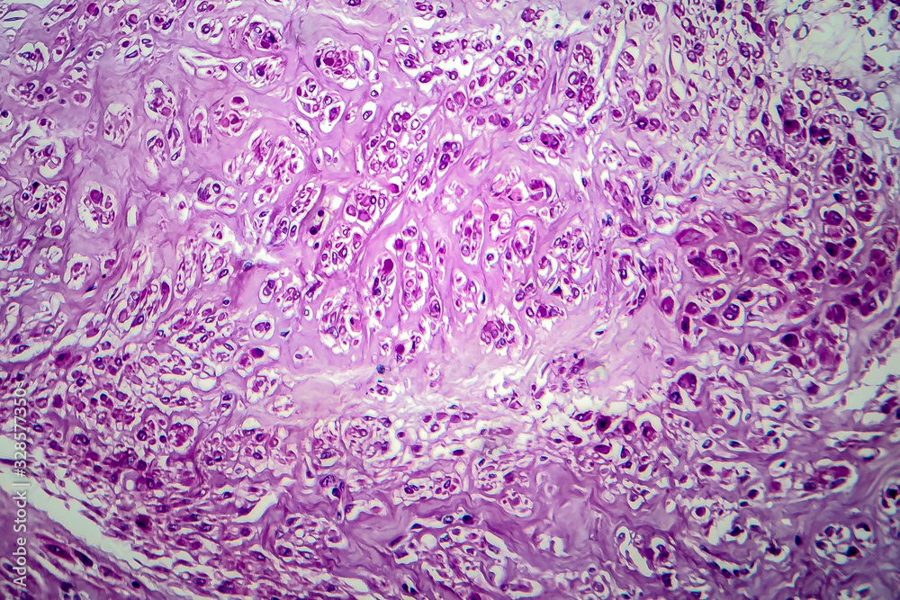 Foto de Uterine leiomyoma, also known as fibroids,a benign smooth ...