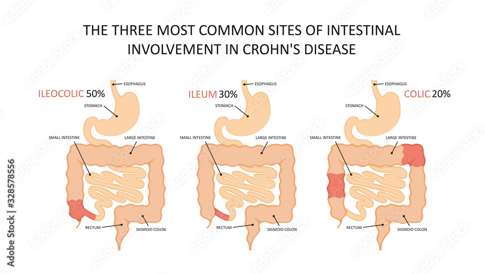 Three most common sites of intestinal involvement in crohn's disease ...