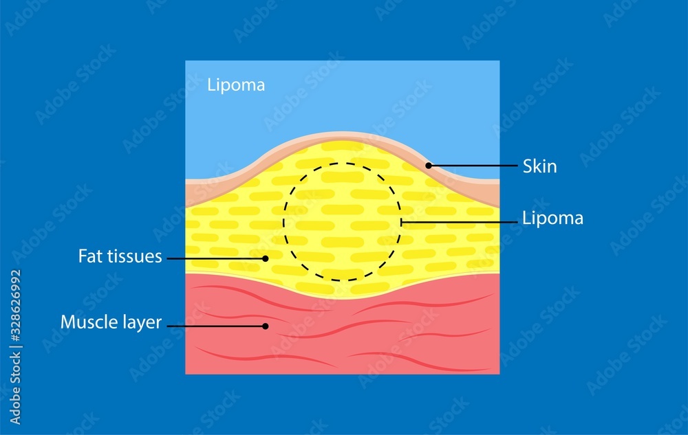 Lipoma disease tissue fatty grows body skin soft hurt pain madelung ...