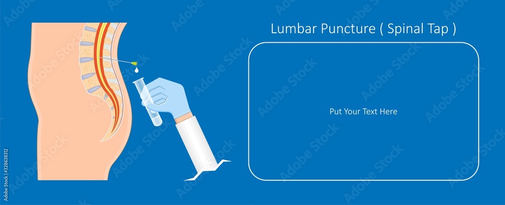 Stockvector lumbar puncture spinal tap canal diagnostic collect sample ...