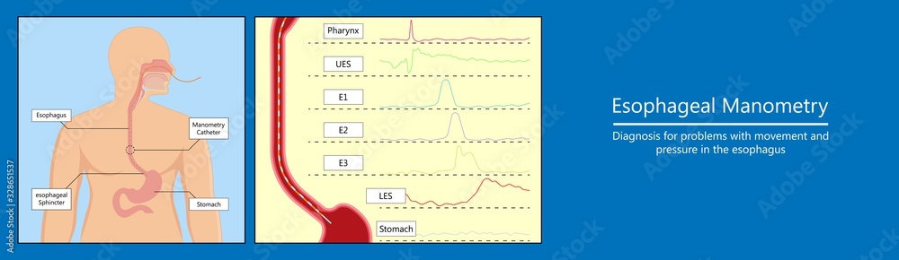 Esophageal manometry test esophageal diagnose food high resolution ...