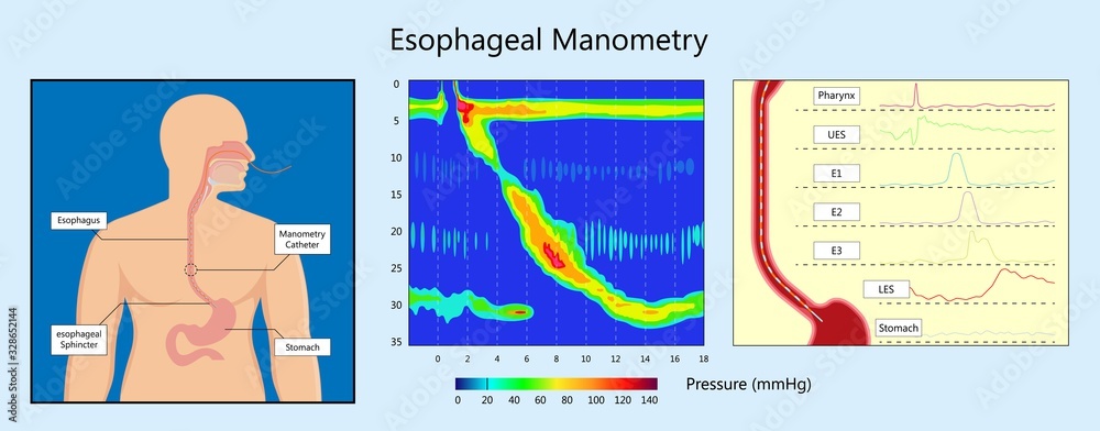 Esophageal manometry test esophageal diagnose food high resolution ...