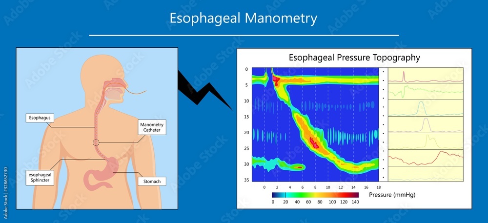 Esophageal manometry test esophageal diagnose food high resolution ...