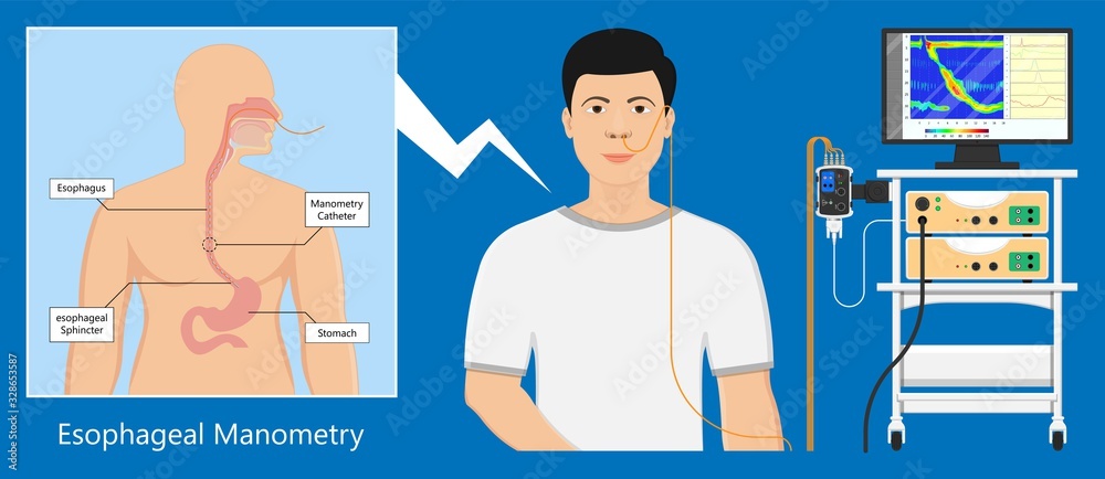 Naklejka Esophageal manometry test esophageal diagnose food high ...