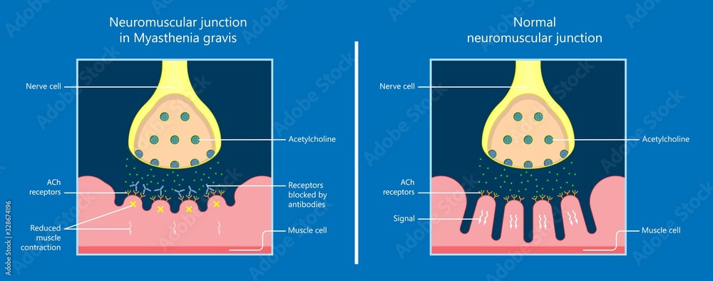 Myasthenia gravis (MG) disease treatment diagnosis testing ...