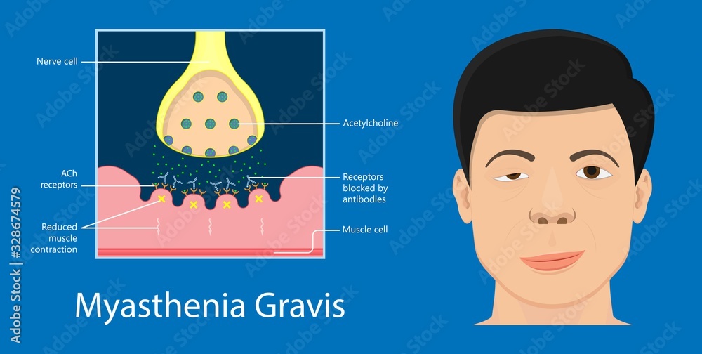 Myasthenia gravis (MG) disease treatment diagnosis testing ...